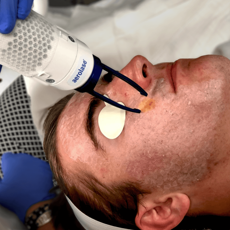 Boss Men Laser Treatments In Haslett Mi Skin Boss 8771
