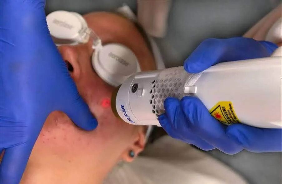 Aerolase LightPod Neo Treatments In Lansing And Haslett, MI