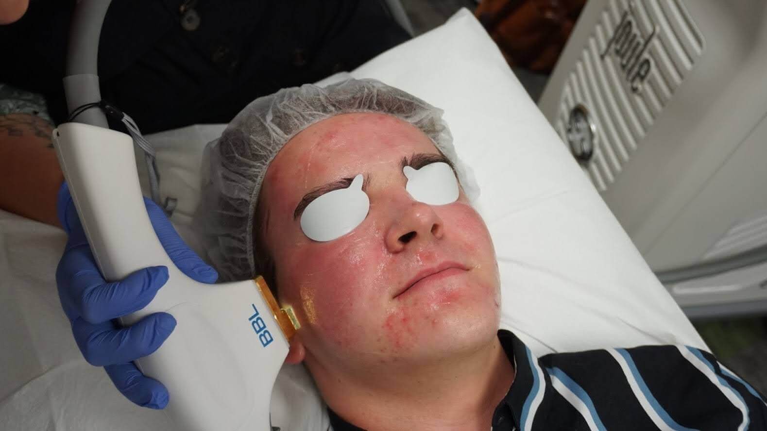 Boss Men | Laser Treatments In Haslett, MI | Skin Boss