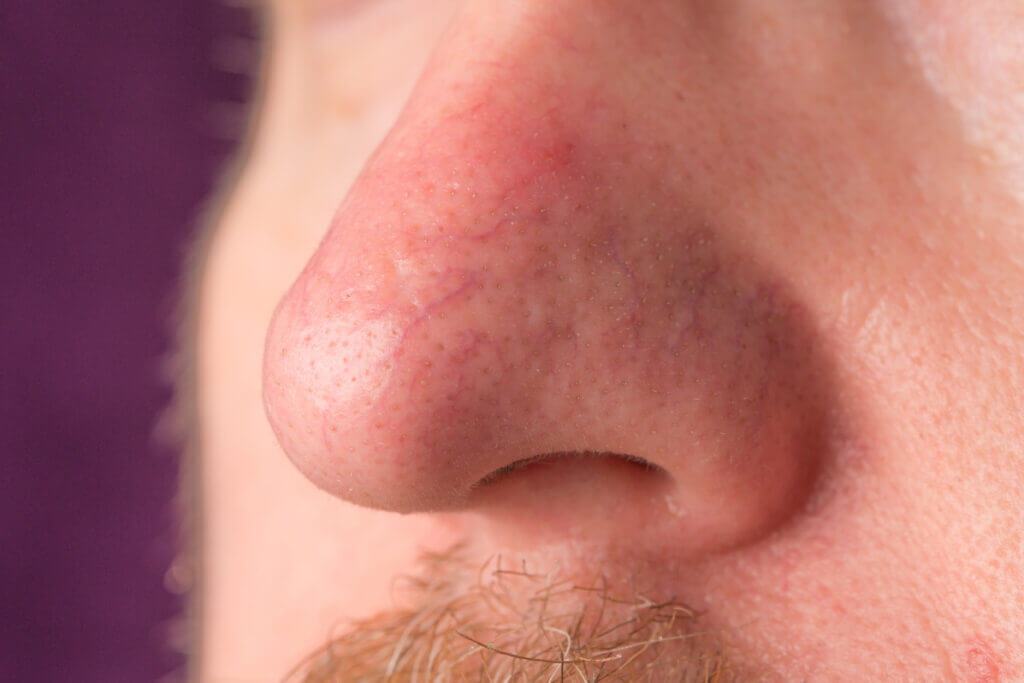 Boss Men Laser Vein Removal In Haslett And Lansing, MI