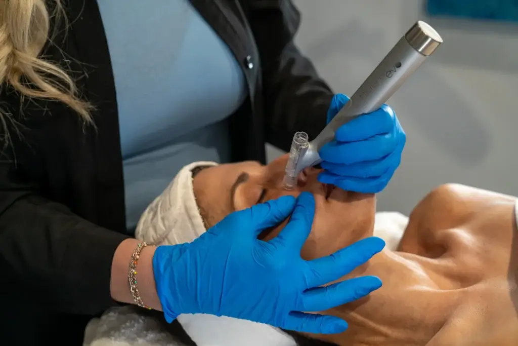 How Microneedling Works To Improve Acne Scars