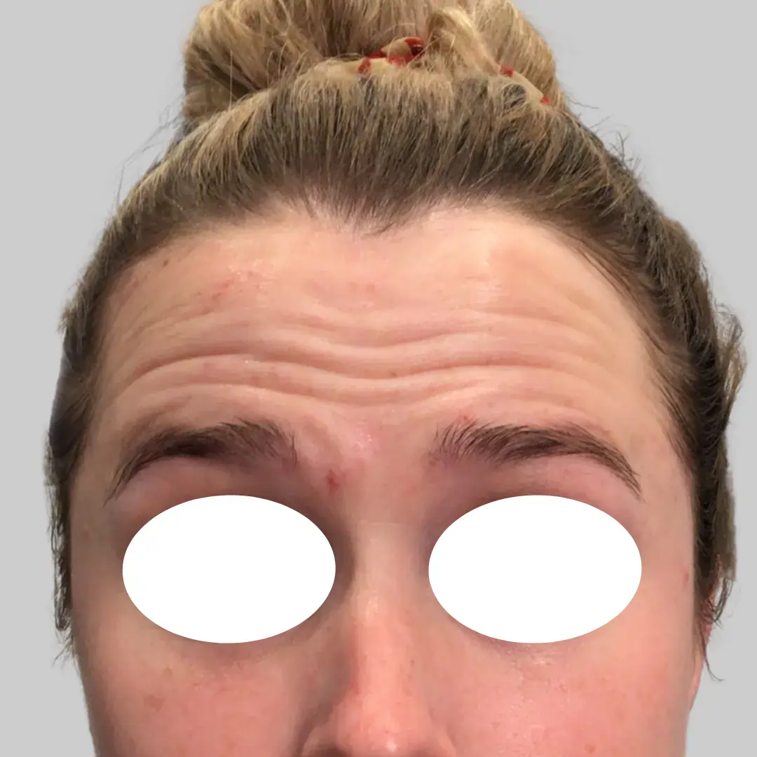 Before And Amazing | Skin Boss Med Spa In Haslett, MI